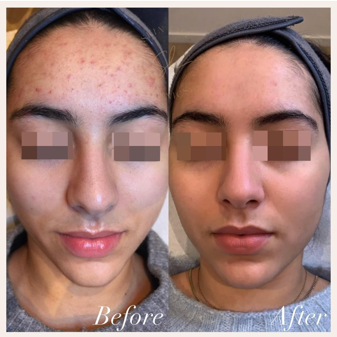 Acnetherapie | Skin Life Clinics