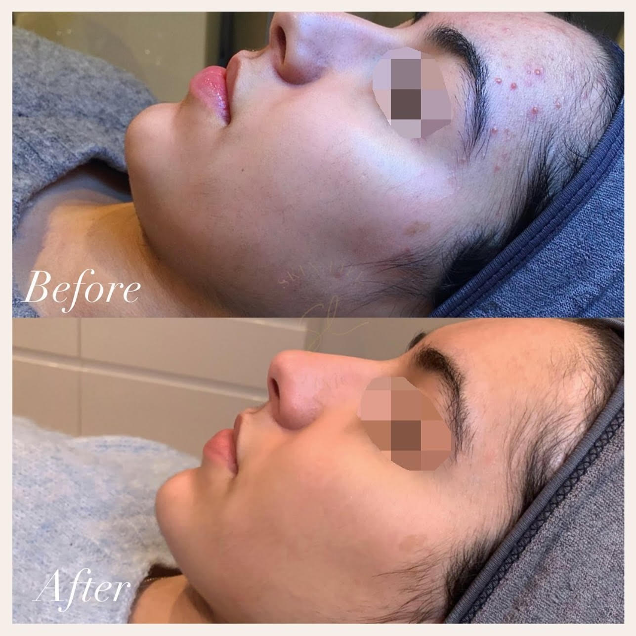 Acnetherapie | Skin Life Clinics